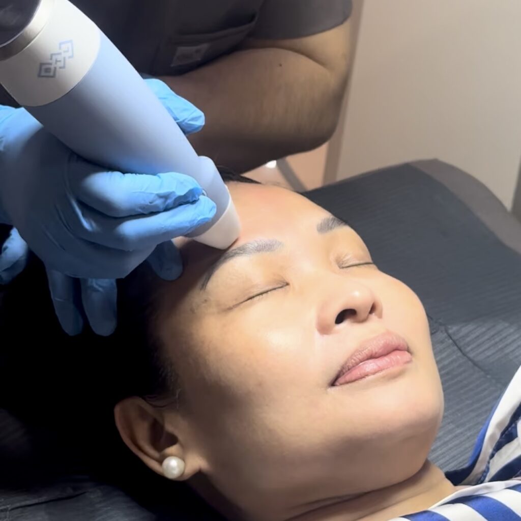 Exion RF Microneedling Treatment - Zionne Beauty Lounge